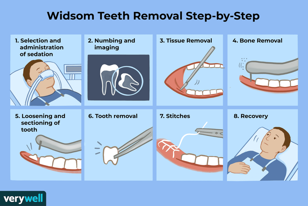 Wisdom Teeth Extractions | Divine Dental Spa | El Paso, TX